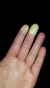 Klachten bij systemische sclerose