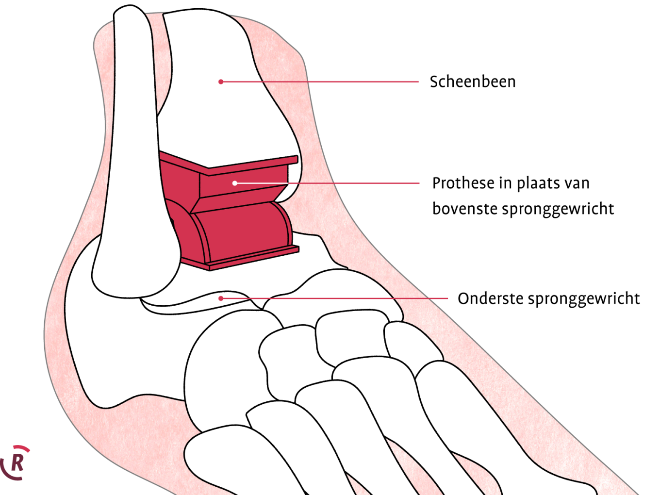 Operatie aan je enkel