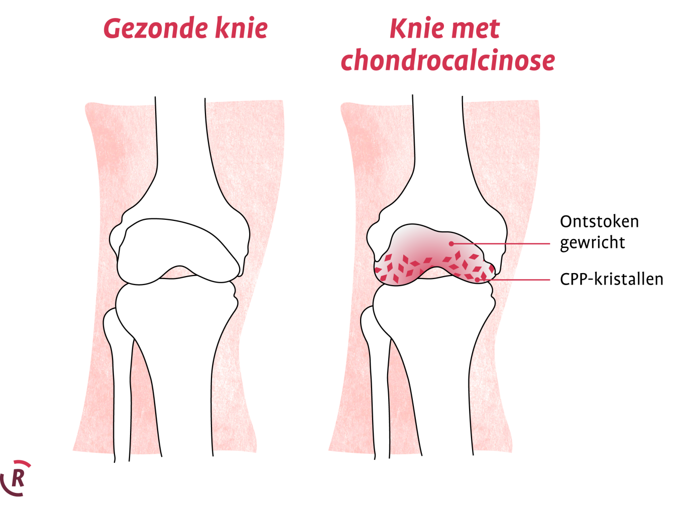 Chondrocalcinose: Symptômes : Chondrocalcinose : Symptômes, diagnostic ...