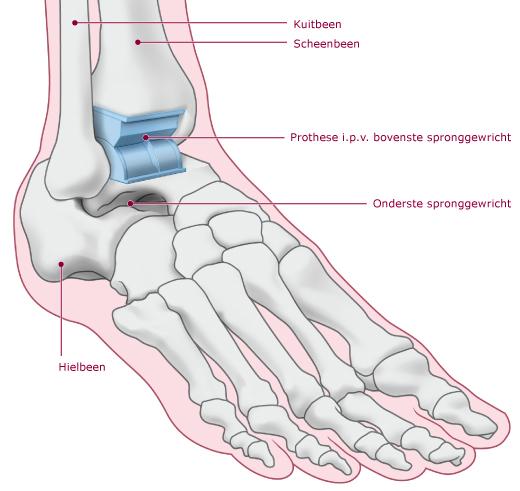 Operatie aan je enkel