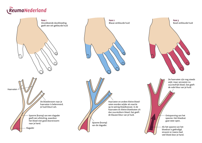 Klachten bij het fenomeen van Raynaud