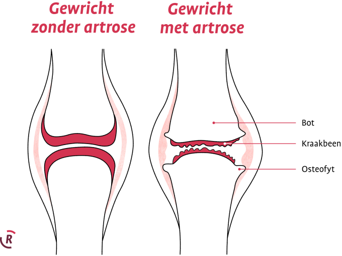 Wat gebeurt er in je gewricht bij artrose?