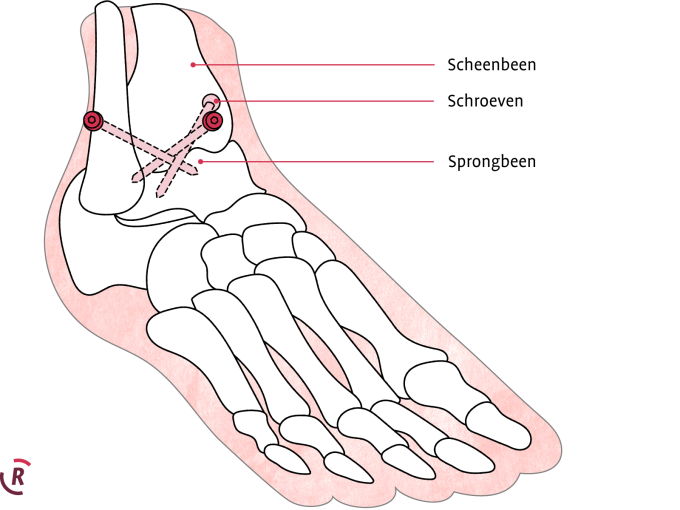 Operatie aan je enkel